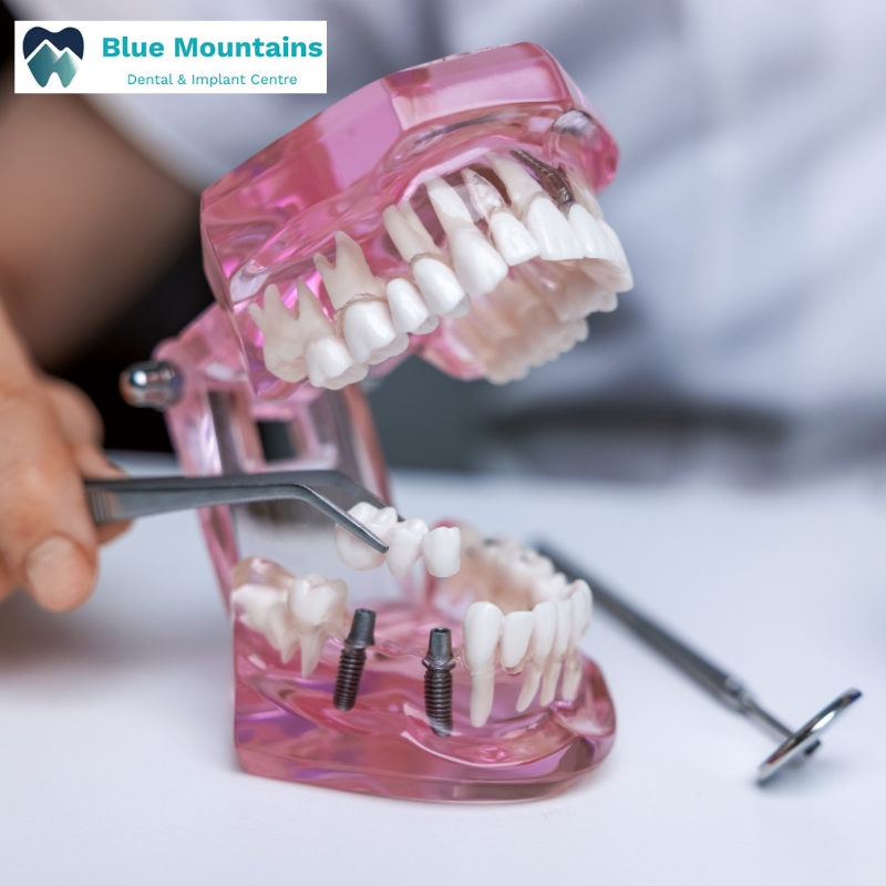 Dental Implants Blackheath NSW 2785 | Blue Mountains Dental